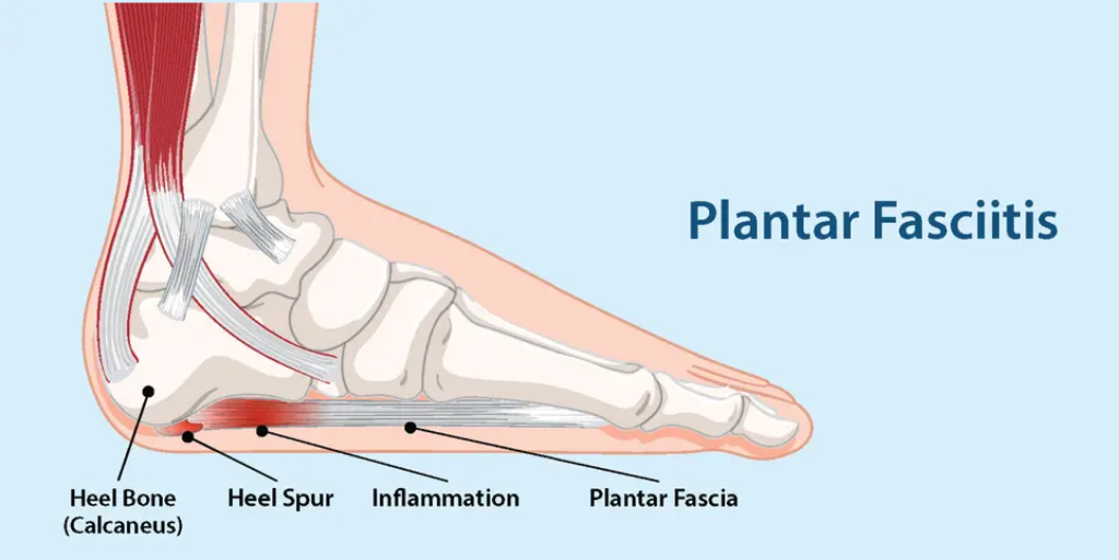 Plantar Fasciitis Treatment: How Physical Therapy Can Relieve Heel Pain ...